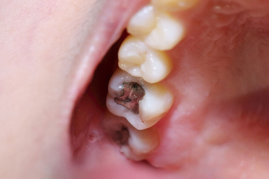 Dental Services | Alliance for Dental Care PLLC